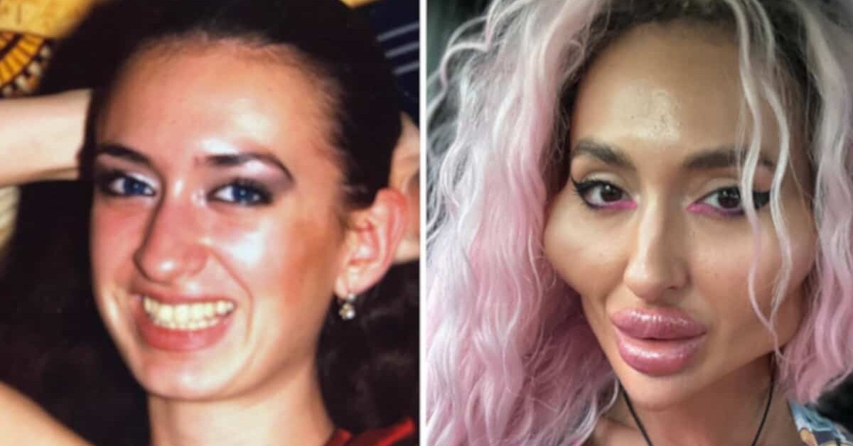 La modella ucraina dalle guance più grandi del mondo preoccupa i fan ...